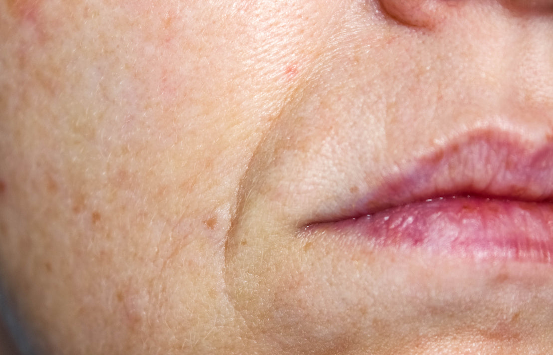 Microneedling for Smile Lines: A Youthful Glow From Home