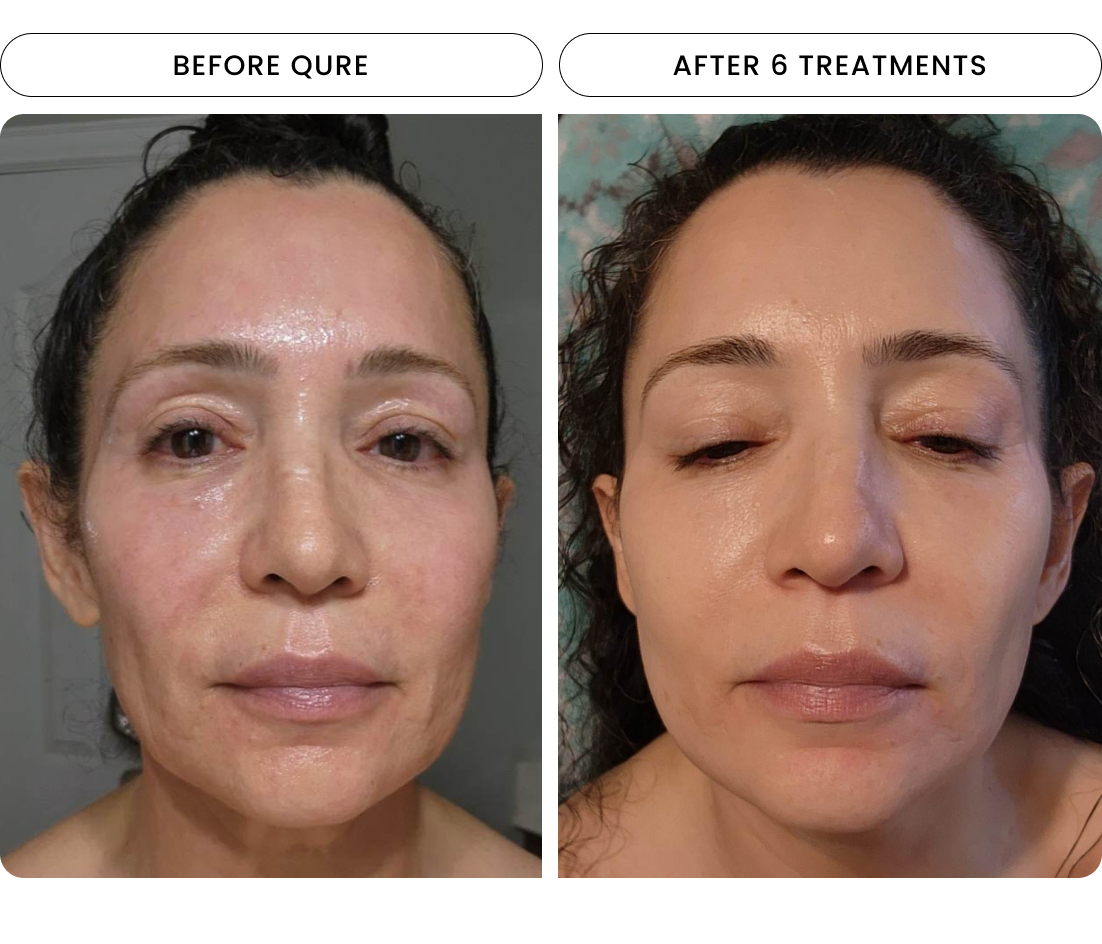 Micro-Infusion For Wrinkles (2 Refill Treatments)