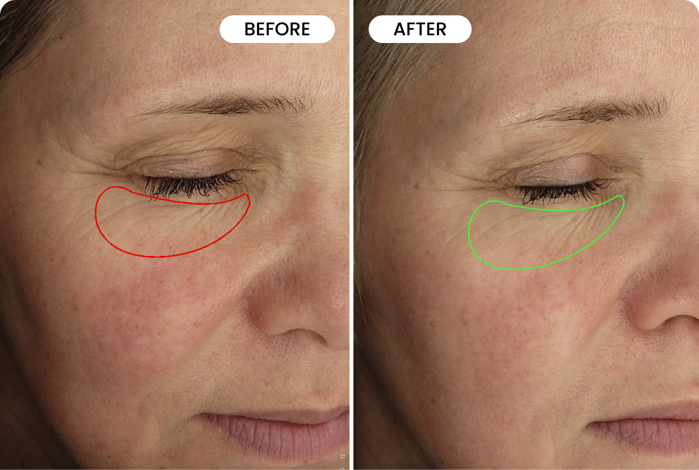 Micro Dart Patches | Target Under Eye & Other Facial Areas