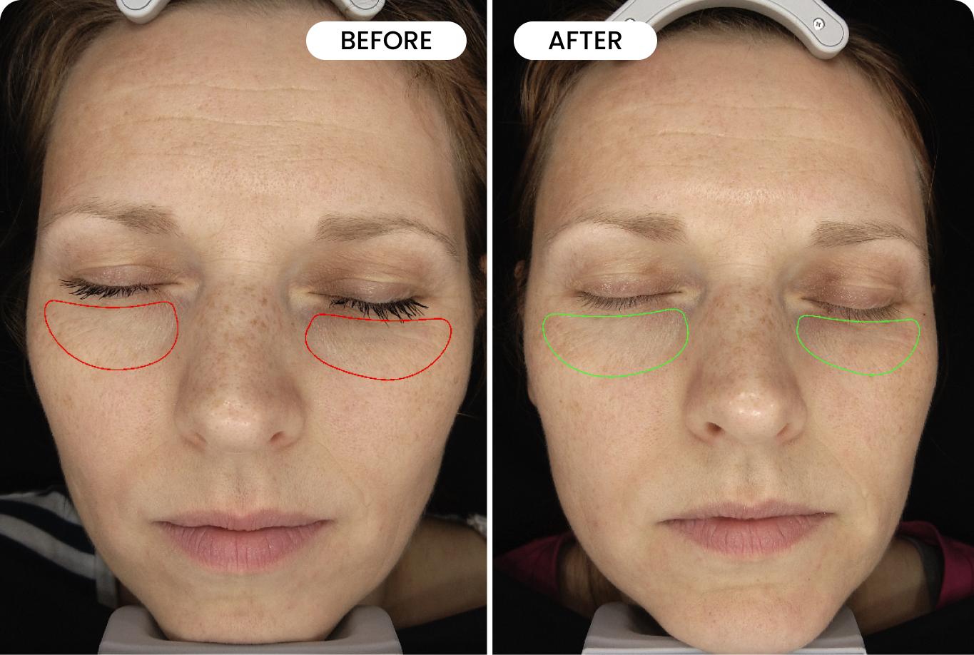 Micro Dart Patches | Target Under Eye & Other Facial Areas