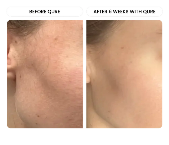 Anti-Aging Serum | All In One Solution For Wrinkles | Qure