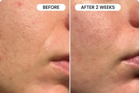 Micro Dart Patches | Target Under Eye & Other Facial Areas