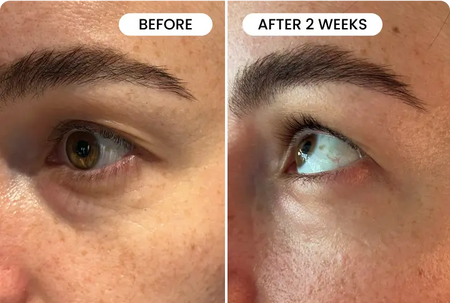 Micro Dart Patches | Target Under Eye & Other Facial Areas