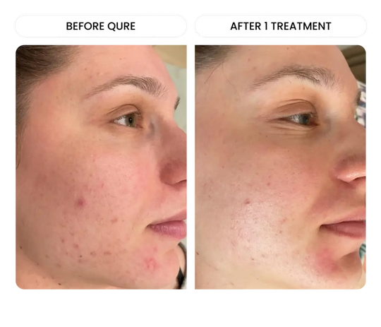 Micro-Infusion System – Qure Skincare