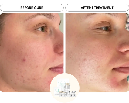 Micro-Infusion System – Qure Skincare