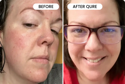 World's First Customizable LED Light Therapy Mask