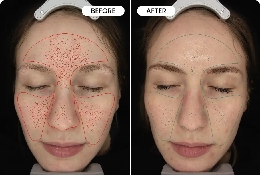 Micro-Infusion System – Qure Skincare