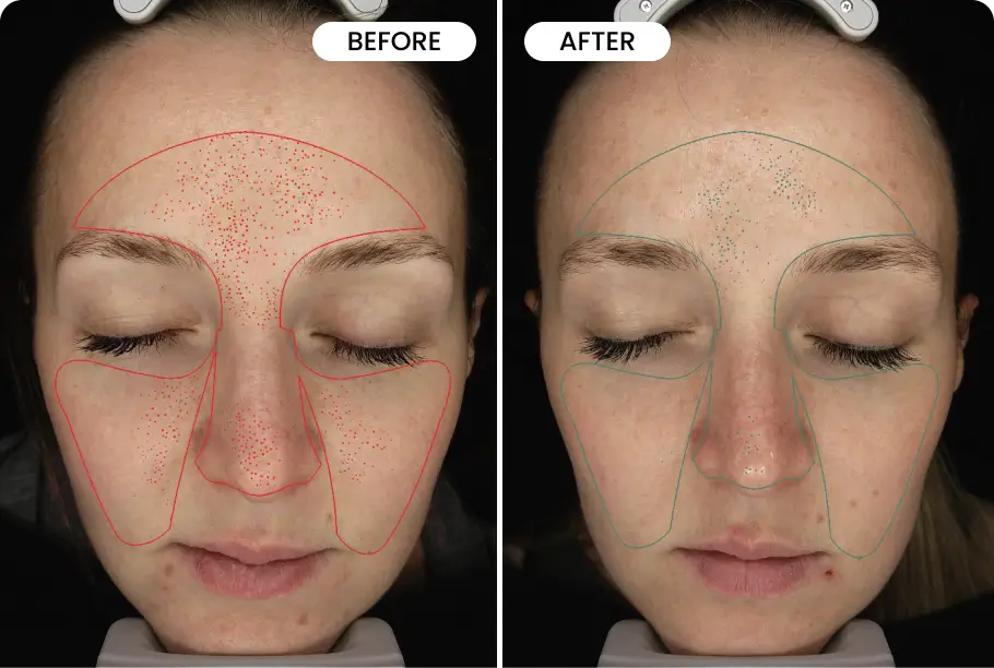 Micro-Infusion System – Qure Skincare